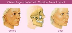 Cheek Implants | Plastic Surgery