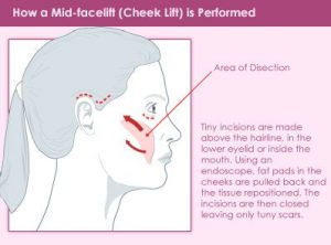 Mid-Facelift – Advanced Cosmetic Surgery